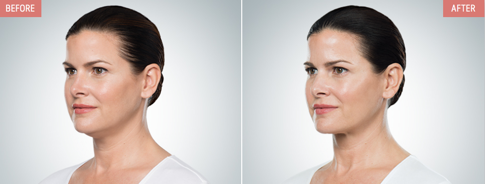 Kybella Injections at Florida Aesthetics & Wellness